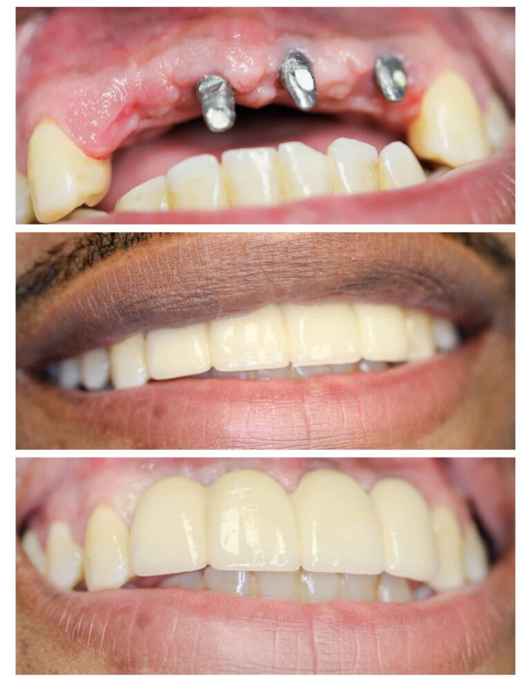 Is implant a good option for geriatric patients? - SmileXpressions ...